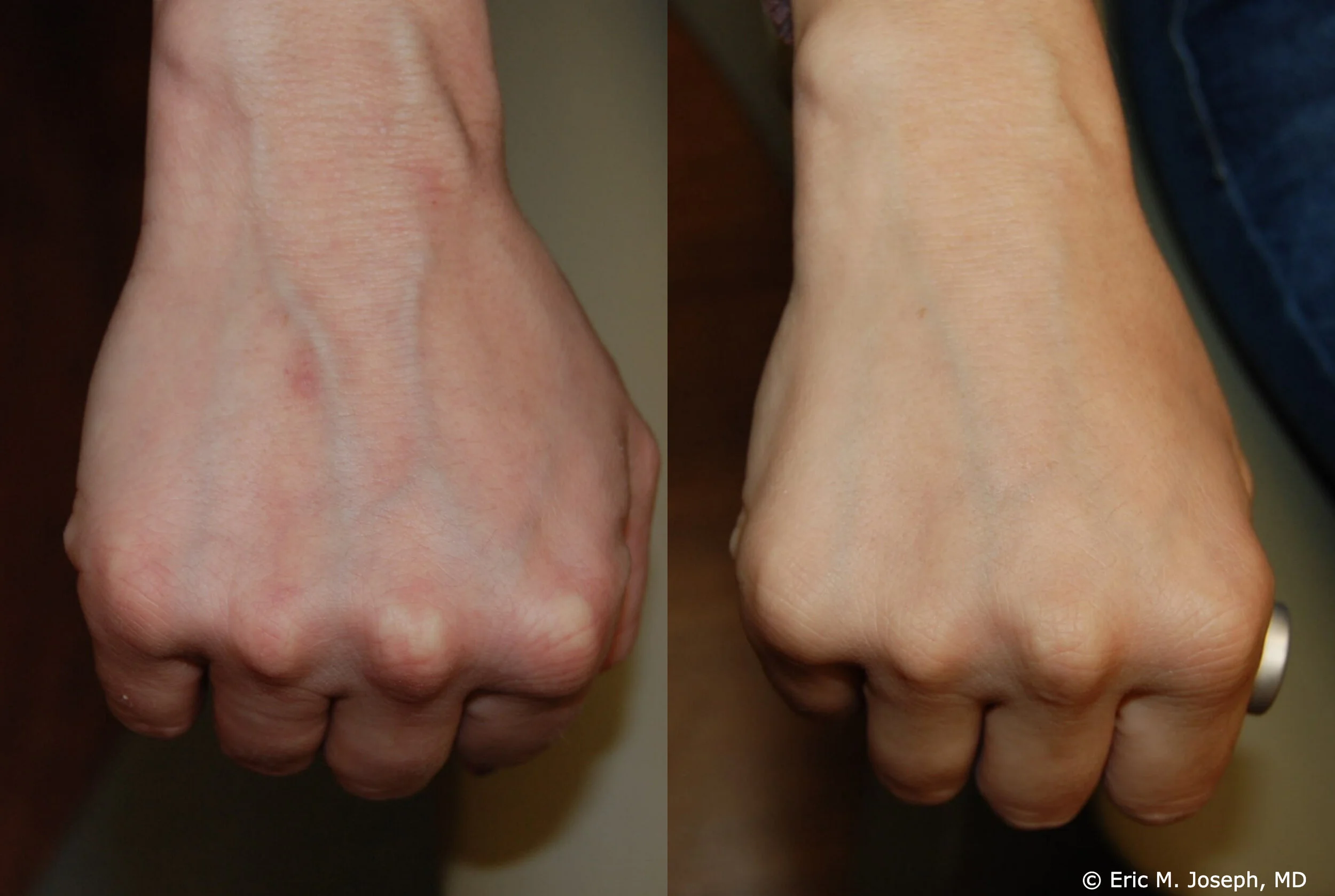 Eric M. Joseph, MD | Hand Rejuvenation