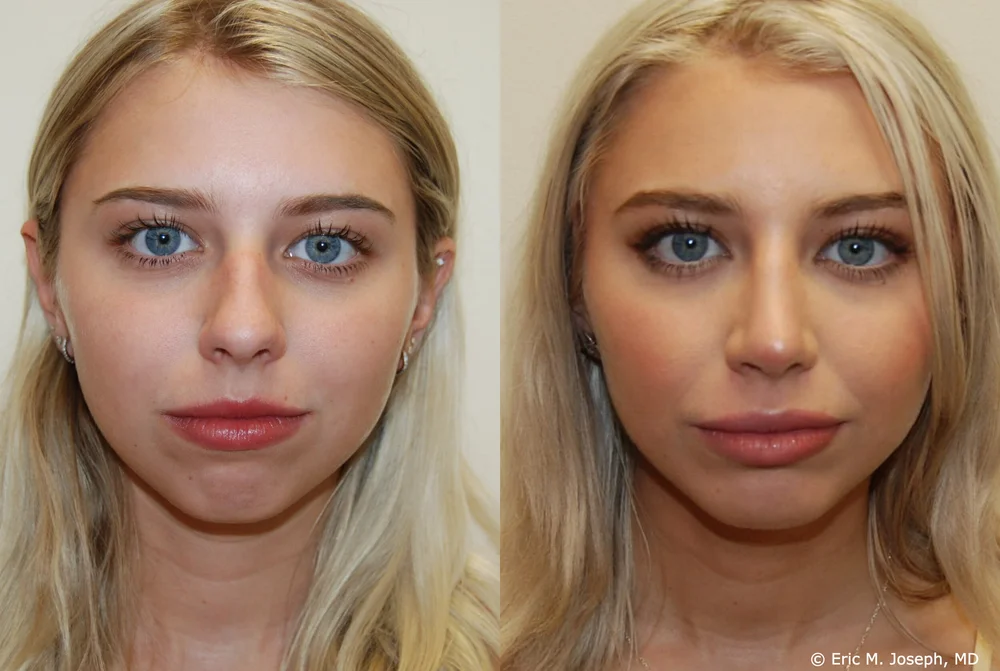 Plastic Surgery Before And After