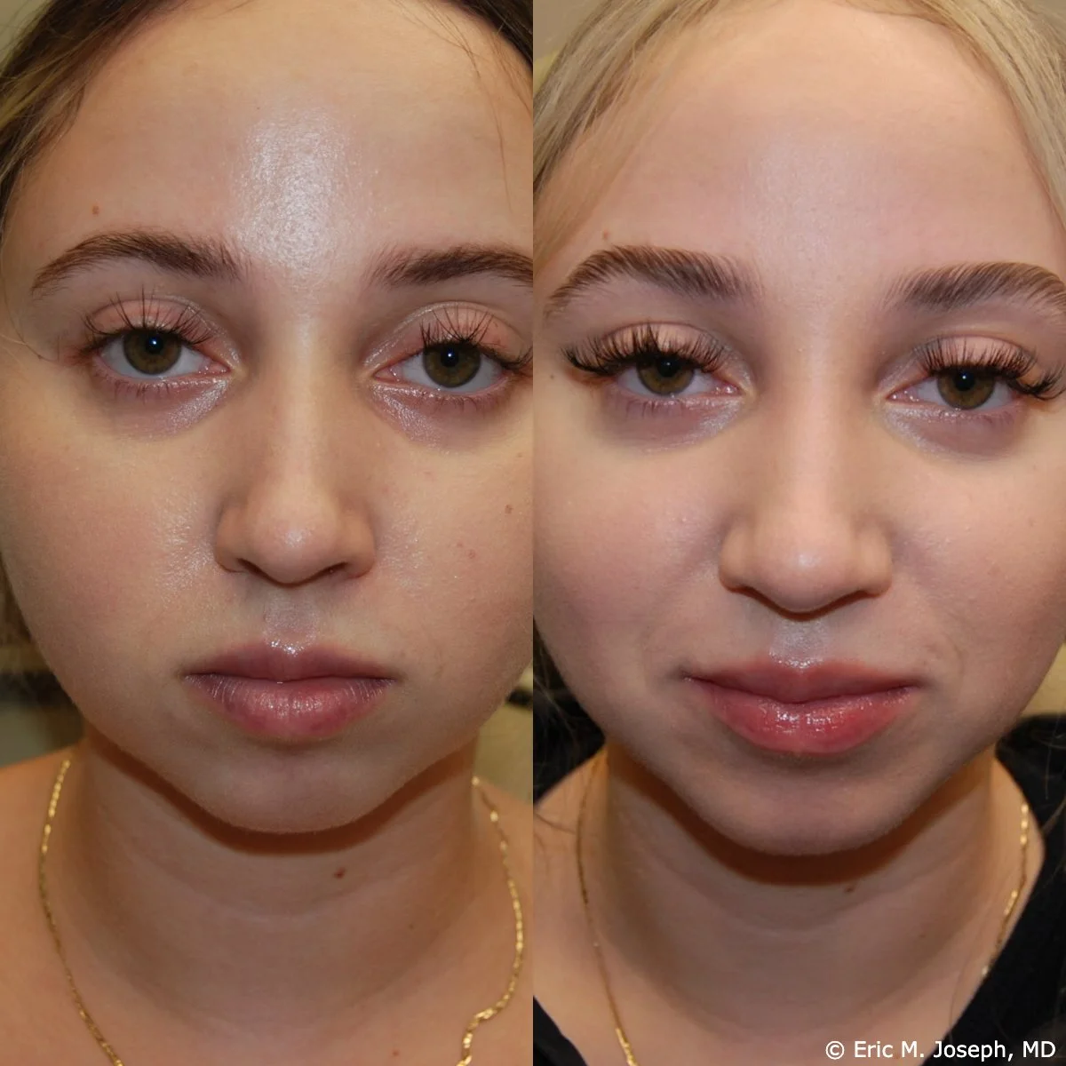 Eric M. Joseph, MD | Silikon-1000 Before & After: Non-Surgical ...