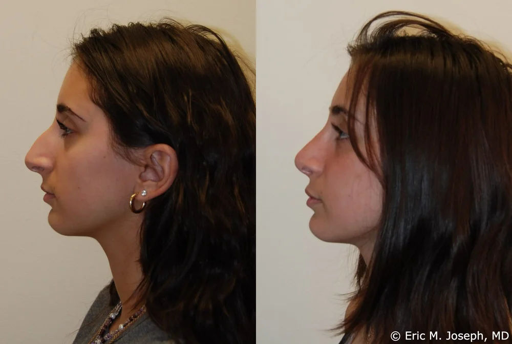 Septoplasty Before And After Inside