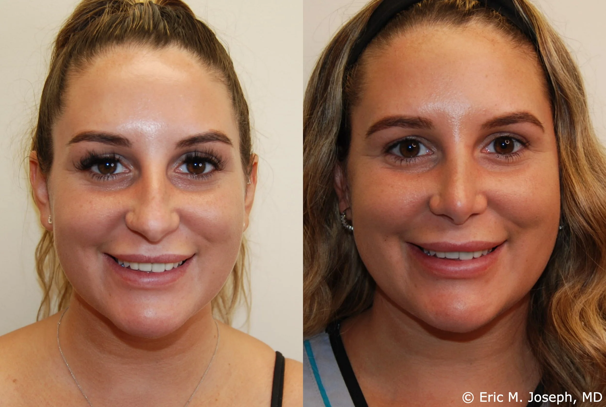 Eric M. Joseph, MD | Rhinoplasty Before & After: Profile Bump and ...