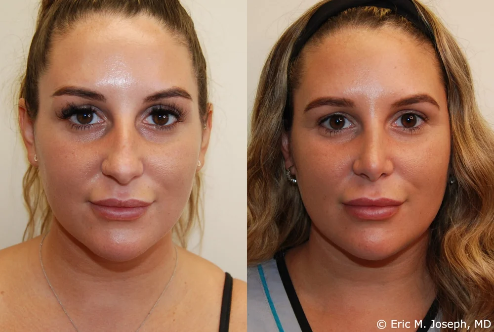 Eric M. Joseph, MD | Rhinoplasty Before & After: Profile Bump and ...