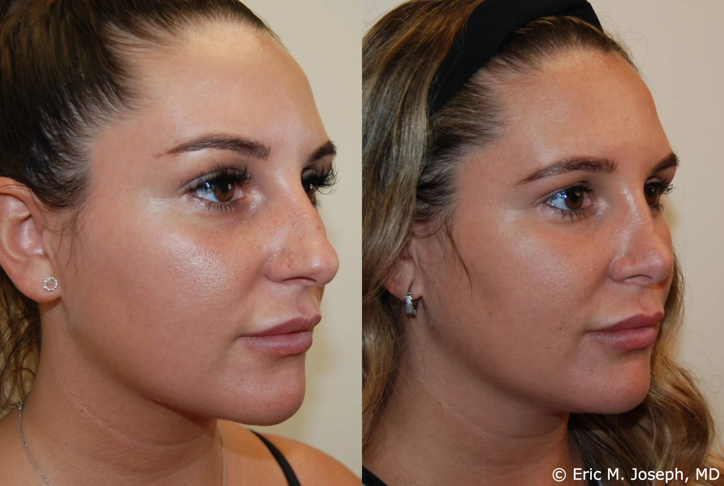 Eric M. Joseph, MD | Rhinoplasty Before & After: Profile Bump and ...