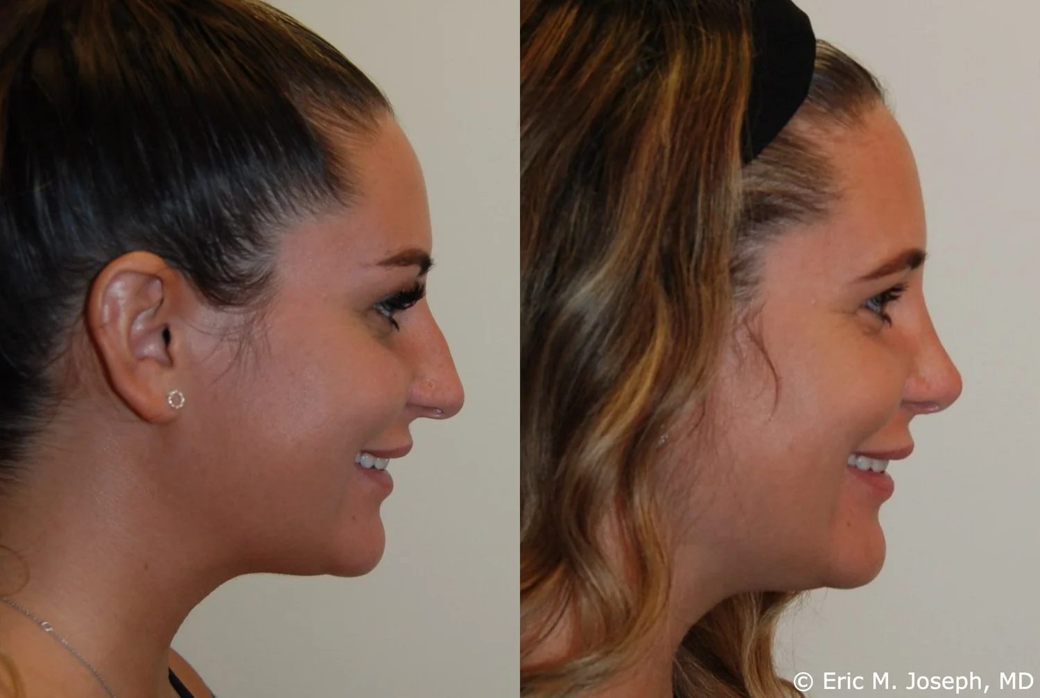 Eric M. Joseph, MD | Rhinoplasty Before & After: Profile Bump and ...