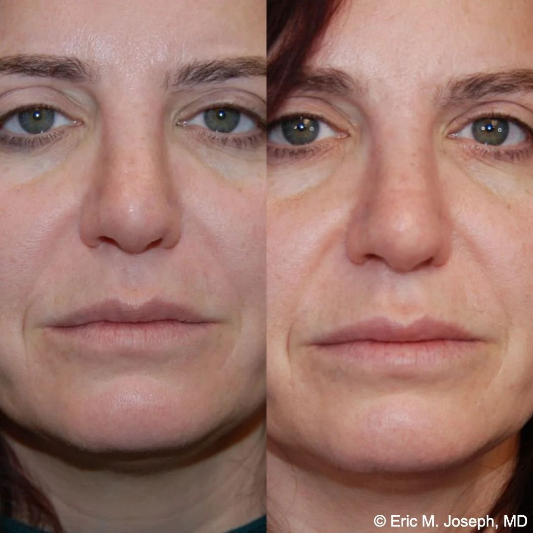 Eric M. Joseph, MD | Permanent Non-Surgical Lip Filler