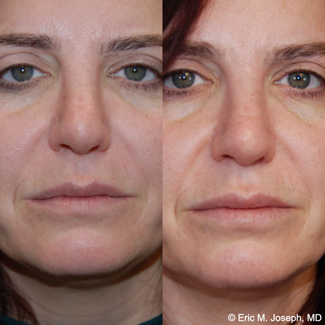 Eric M. Joseph, MD | Silikon-1000 Before & After: Permanent Lip ...