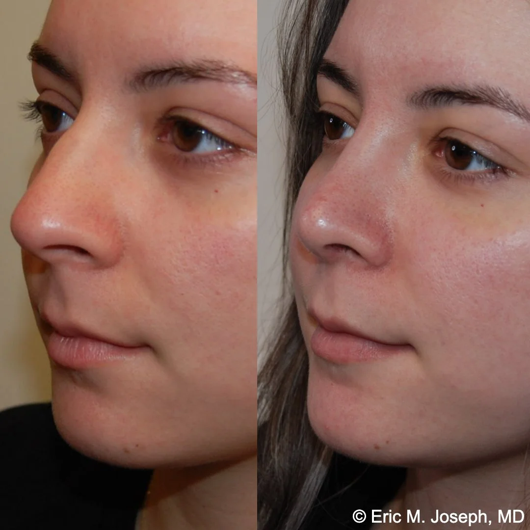 Eric M. Joseph, MD | Rhinoplasty Before & After: Corrected Nasal Flaring
