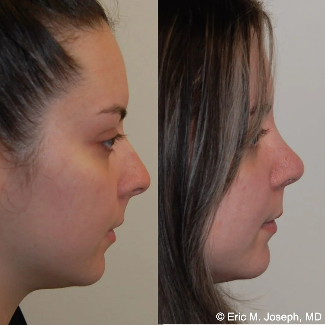 Eric M. Joseph, MD | Rhinoplasty Before & After: Corrected Nasal Flaring