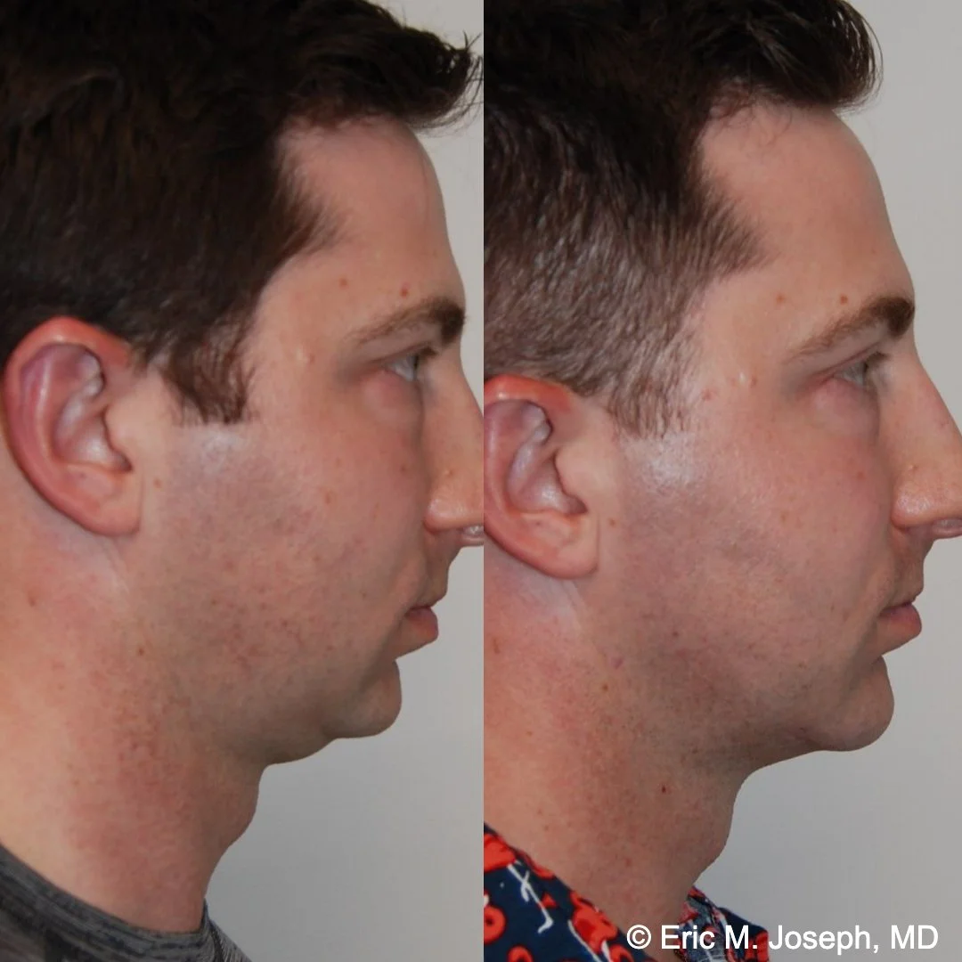 Eric M. Joseph, MD | Chin & Neck Before & After: Decrease Double Chin ...