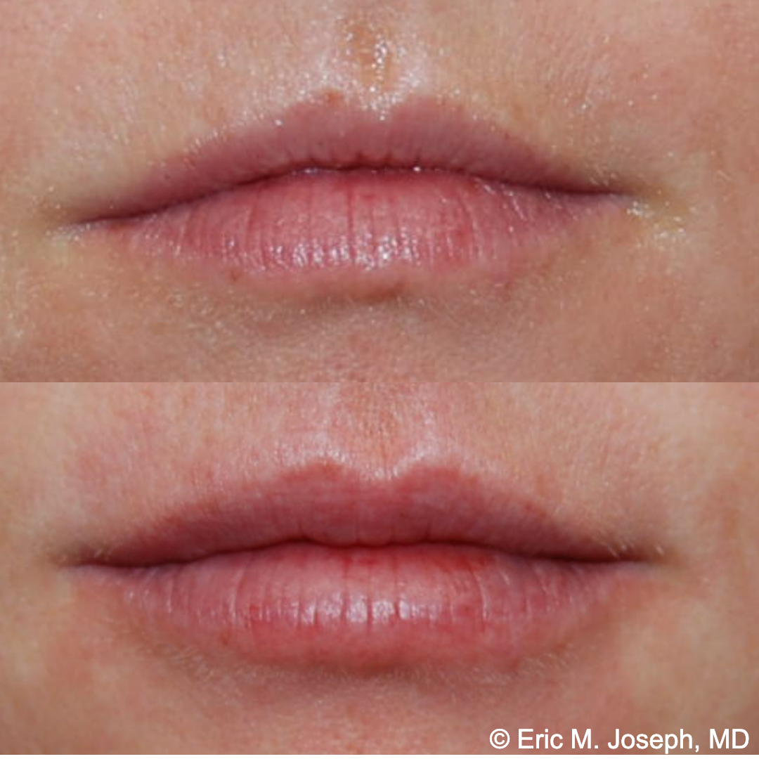 Eric M. Joseph, MD | Permanent Non-Surgical Lip Filler