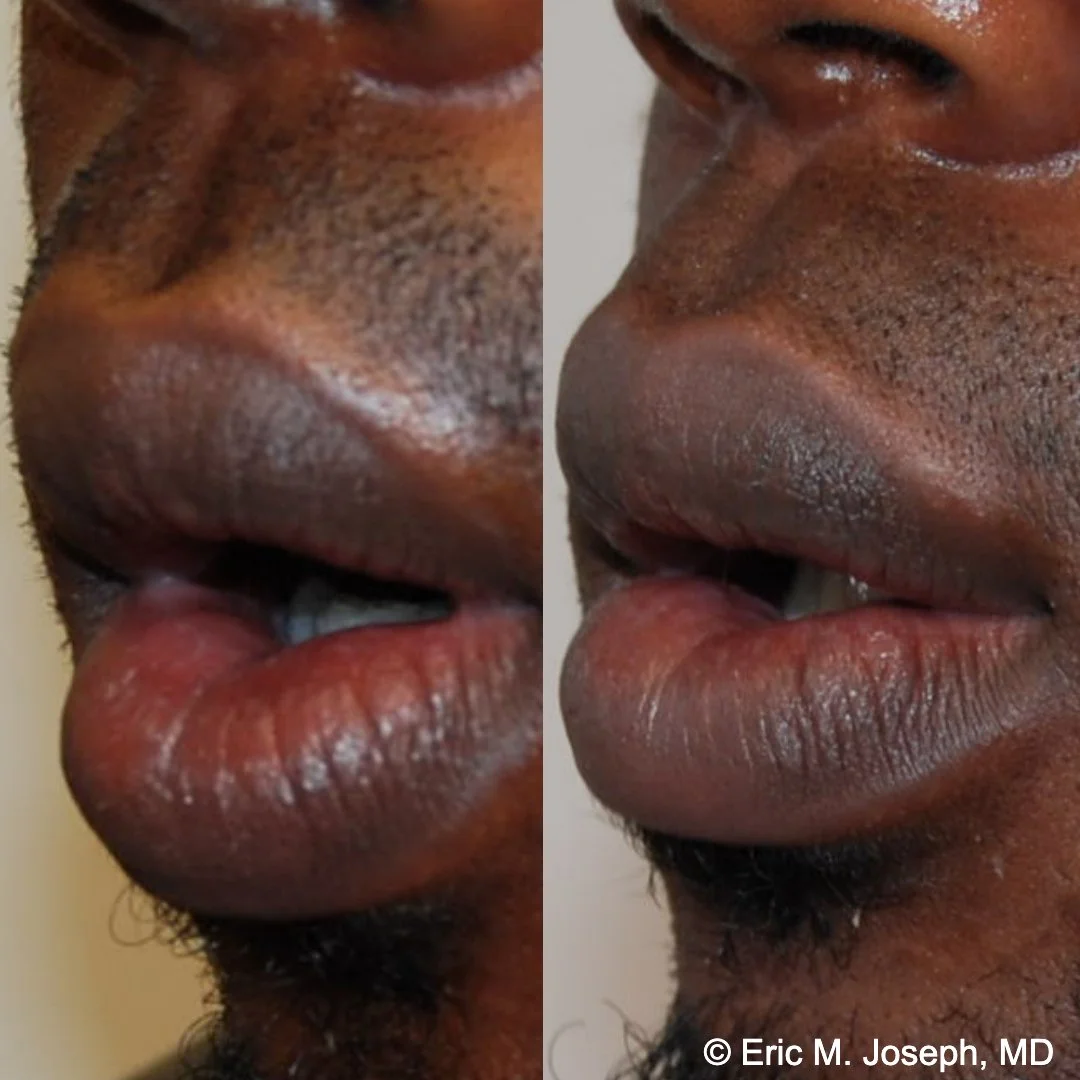 Eric M. Joseph, MD | Lip Reduction Surgery Photo Gallery