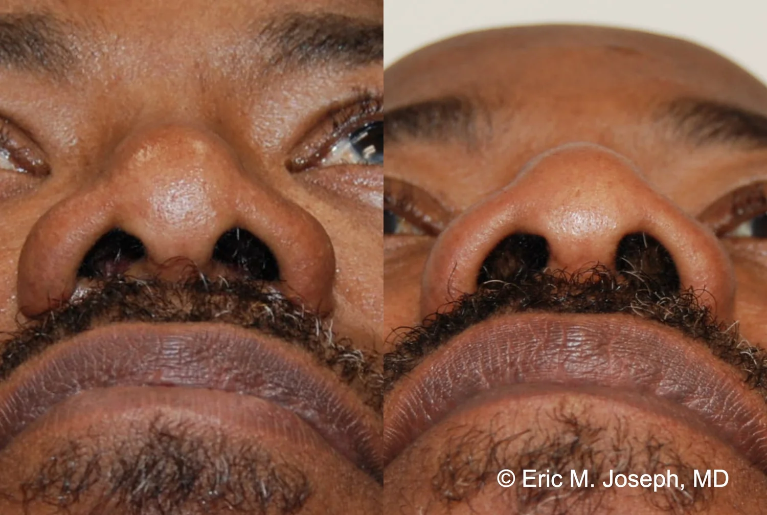 Eric M. Joseph, MD | Permanent Non Surgical Rhinoplasty/ Nose Job