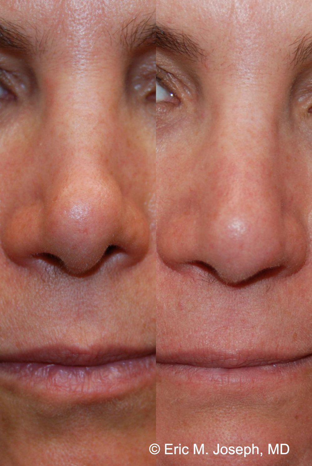 Eric M. Joseph, MD | Permanent Non Surgical Rhinoplasty/ Nose Job
