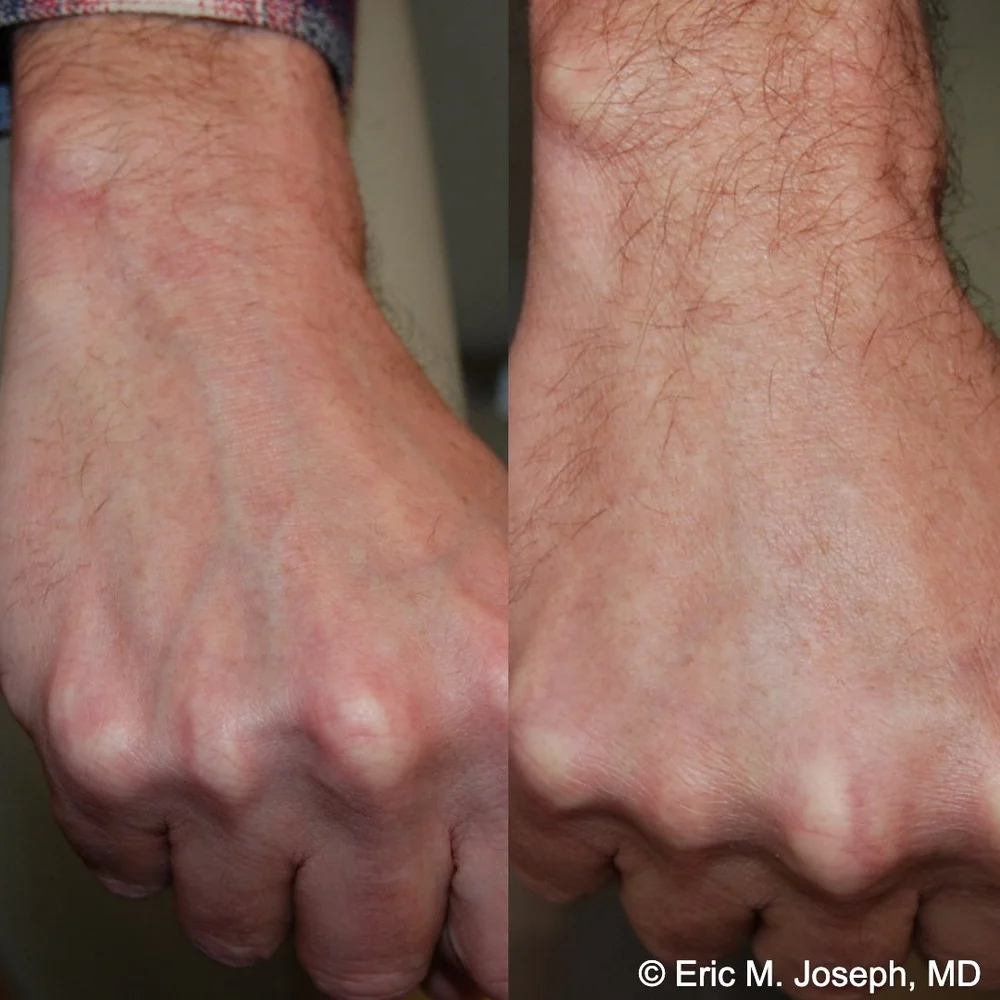 Eric M. Joseph, MD | Hand Rejuvenation