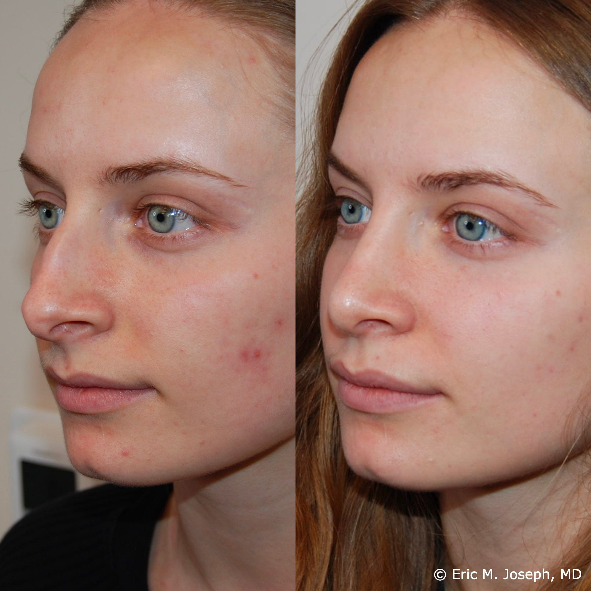 Eric M. Joseph, MD | Rhinoplasty Before & After: Recovery 7 Months ...