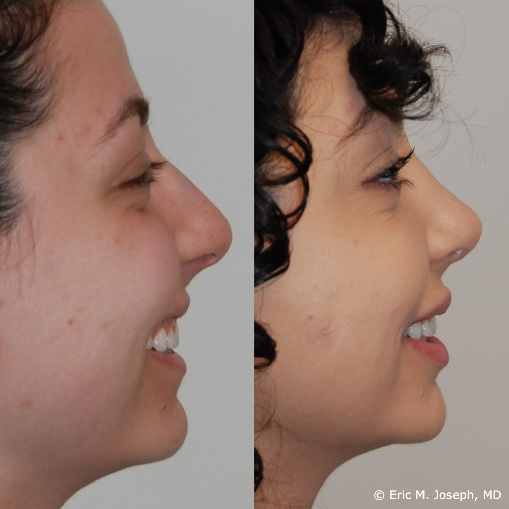Eric M. Joseph, MD | Primary Rhinoplasty Gallery
