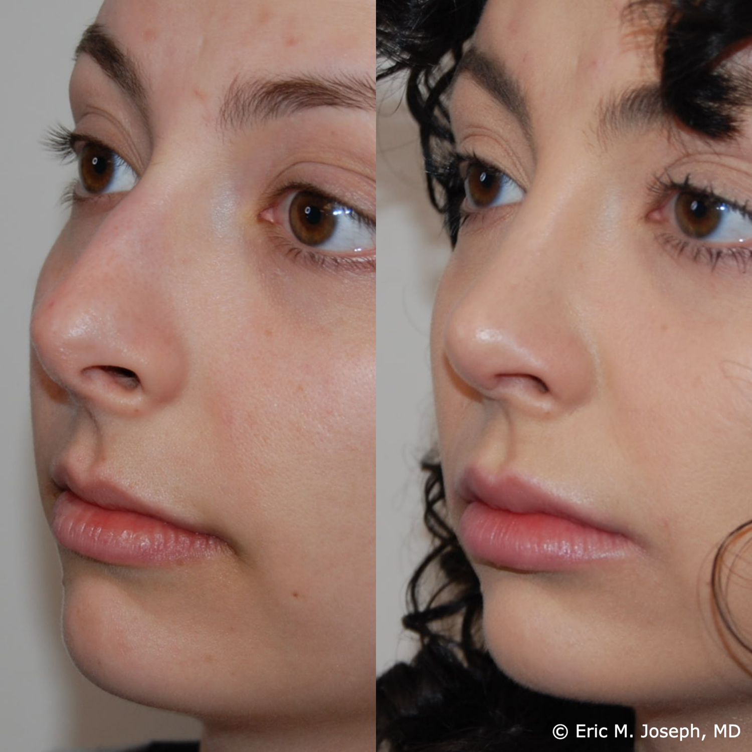 Eric M. Joseph, MD | Primary Rhinoplasty Gallery