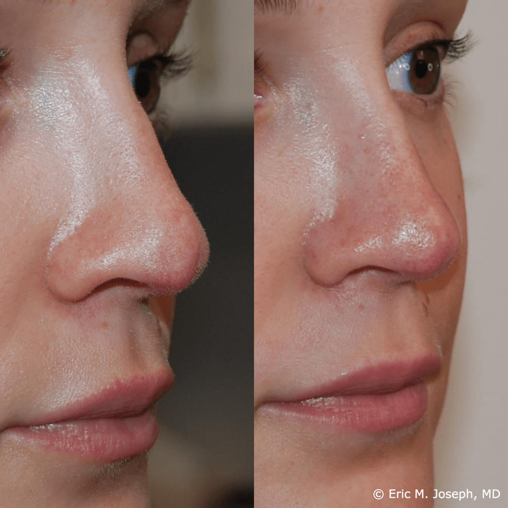Eric M. Joseph, MD | Permanent Non Surgical Rhinoplasty/ Nose Job