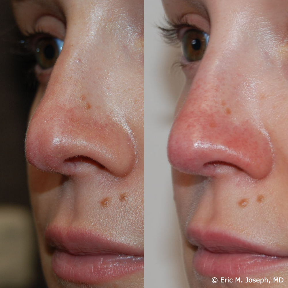 Eric M. Joseph, MD | Silikon-1000 Before & After: To Correct a Previous ...