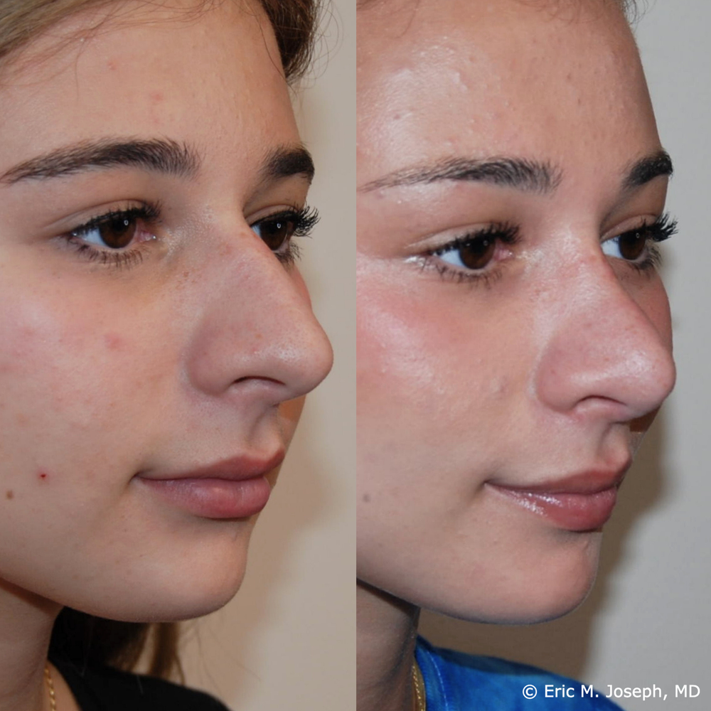 Eric M. Joseph, MD | Primary Rhinoplasty Gallery