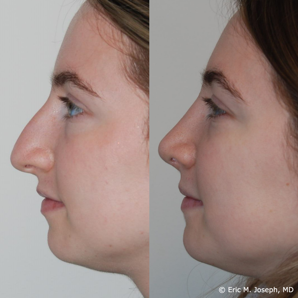 Eric M. Joseph, MD | Rhinoplasty Before & After: Corrected ...