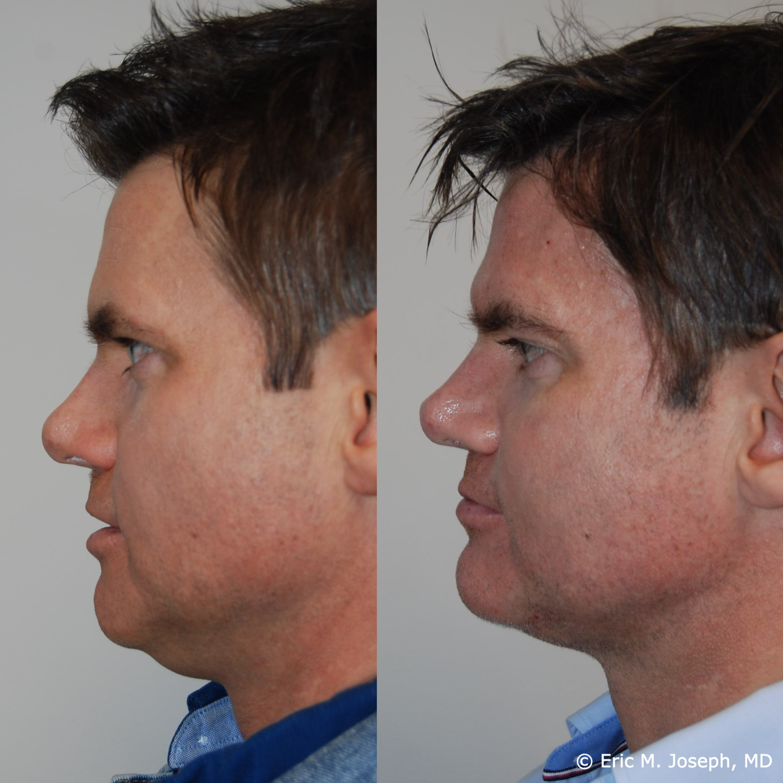 Eric M. Joseph, MD | Chin & Neck Before & After: Three Months Post-op ...