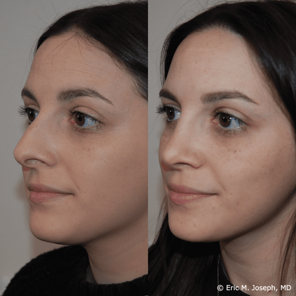 Eric M. Joseph, MD | Rhinoplasty Before & After: Addressed a Hanging ...