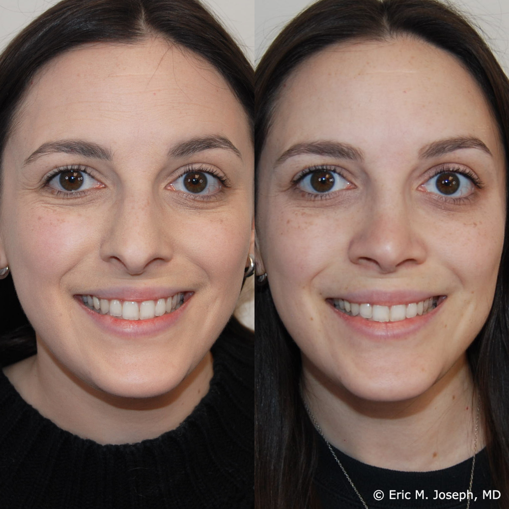 Eric M. Joseph, MD | Rhinoplasty Before & After: Addressed a Hanging ...