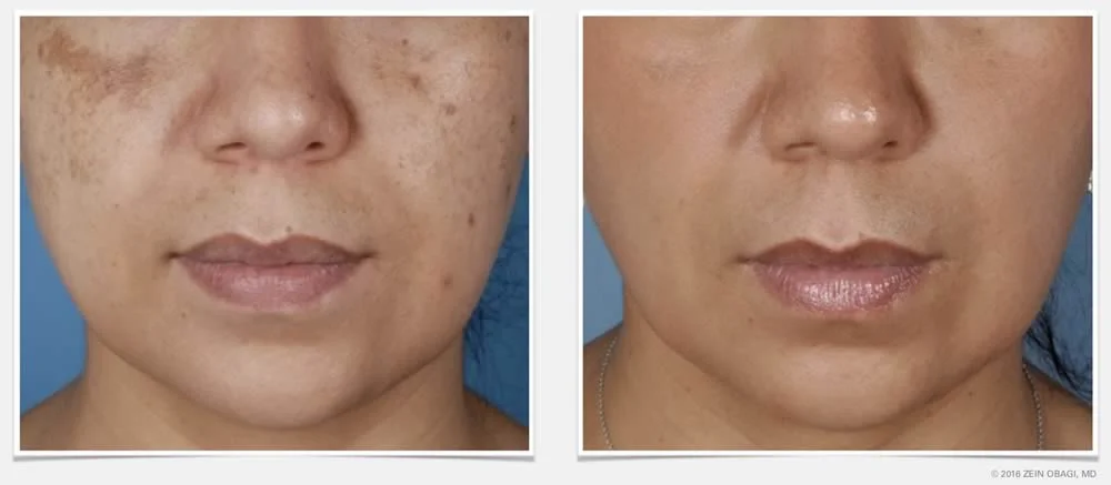 Hyperpigmentation — Dr Paul Baines —Taunton