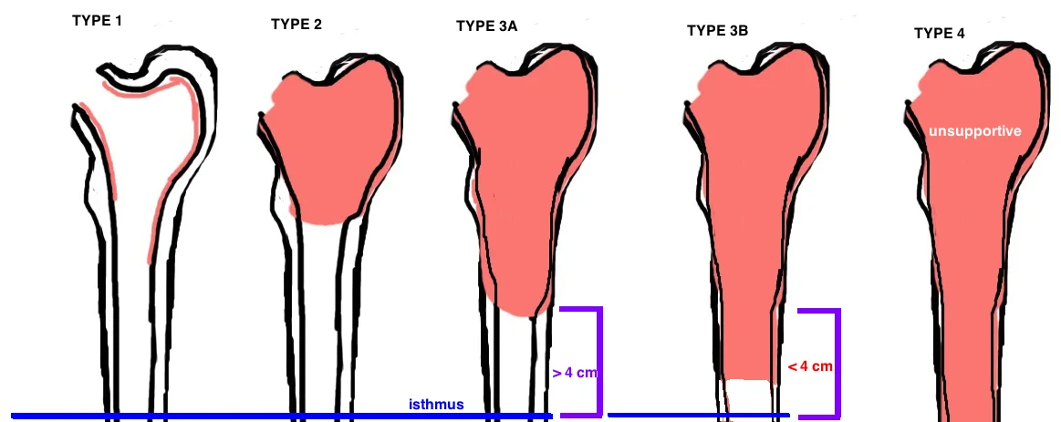 OSTEOLYSIS & ASEPTIC LOOSENING — Hip & Knee Book