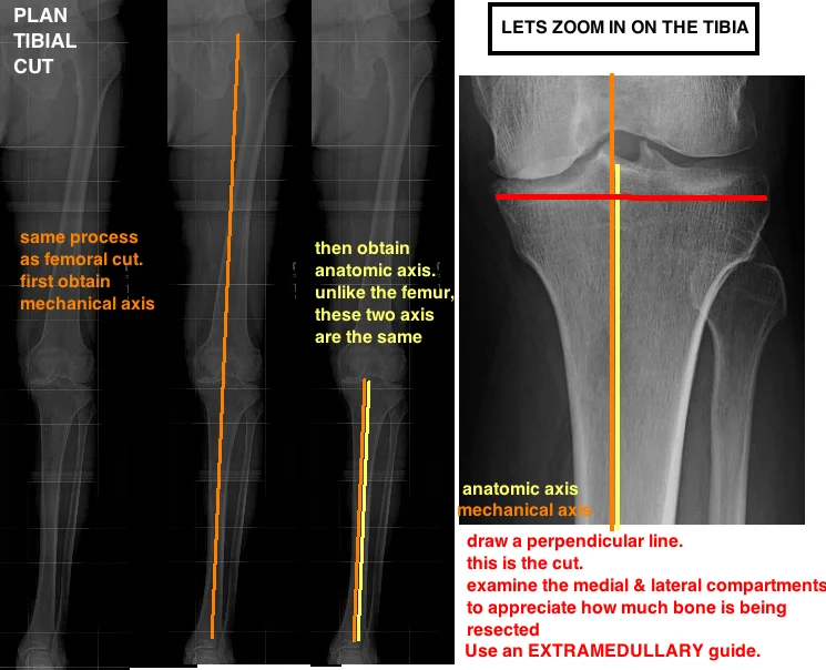 TKA ALIGNMENT — Hip & Knee Book