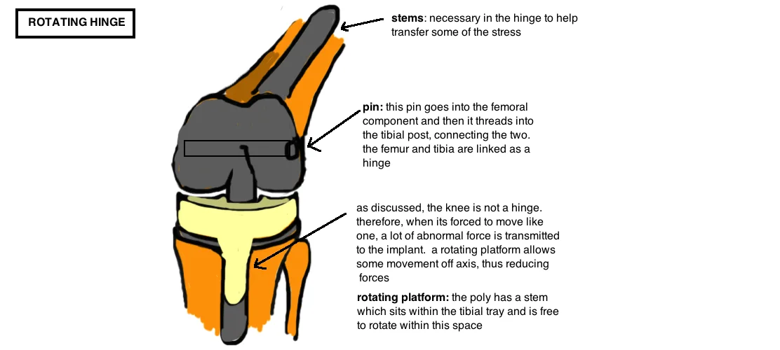 TKA - REVISION DESIGNS — Hip & Knee Book