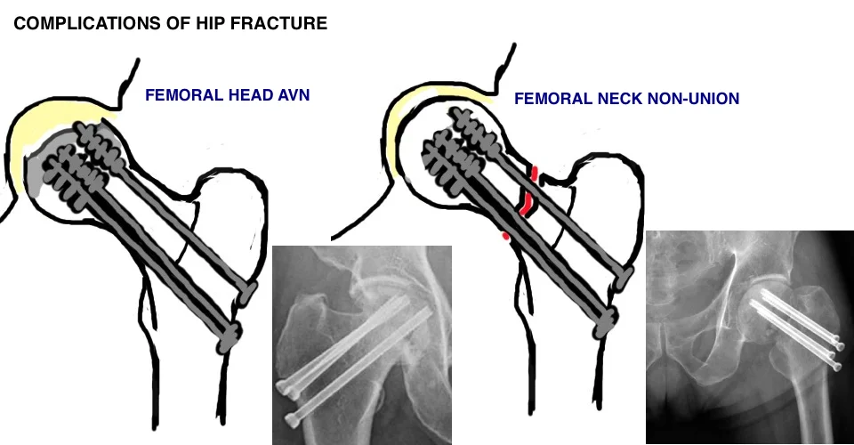 Failed Surgery of Hip Fracture — Hip & Knee Book