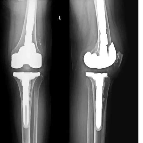 KNEE SYSTEMS ATLAS — Hip & Knee Book
