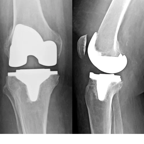 KNEE SYSTEMS ATLAS — Hip & Knee Book