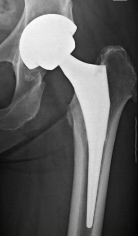 HIP SYSTEMS — Hip & Knee Book