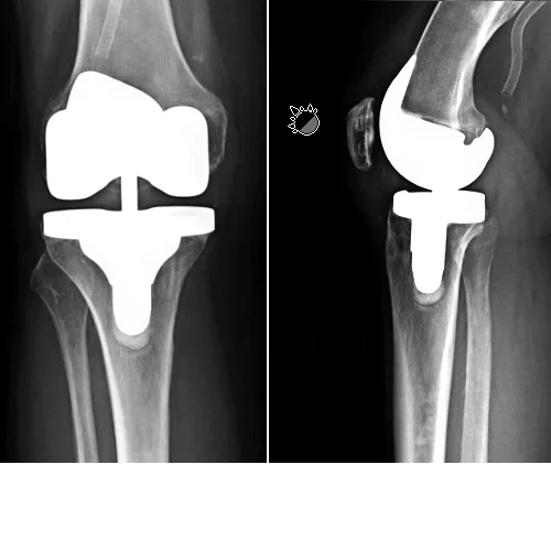 KNEE SYSTEMS ATLAS — Hip & Knee Book