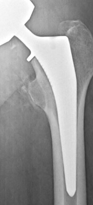 IMPLANT ATLAS — Hip & Knee Book