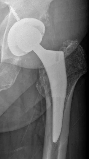 HIP SYSTEMS — Hip & Knee Book