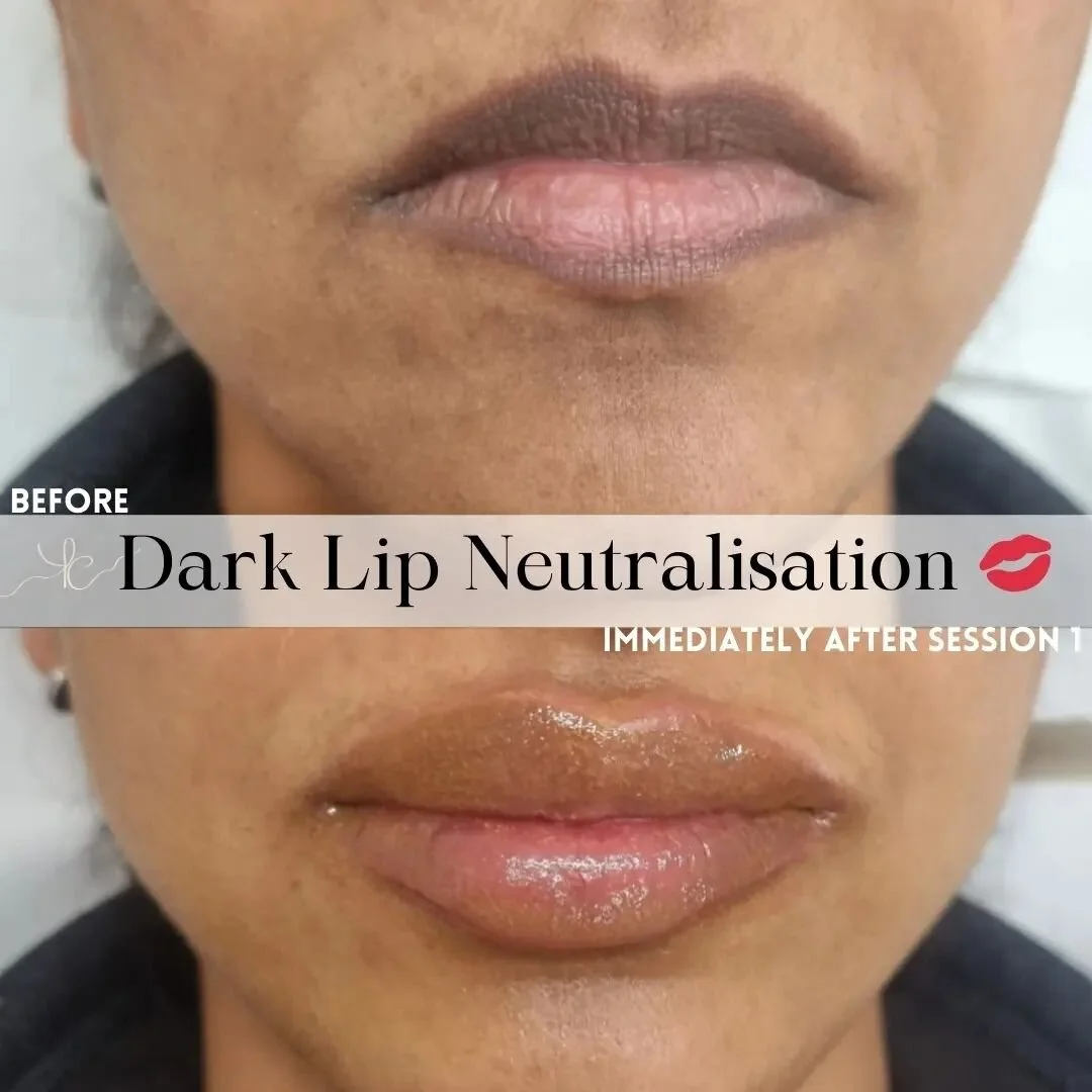 KANDOR CO. Skin Camouflage UK, Scalp Micropigmentation UK, Scar ...