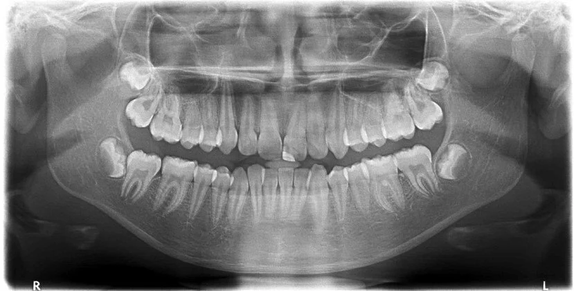 What are OPG and CBCT scans... and why you may need one? — tooth dental ...