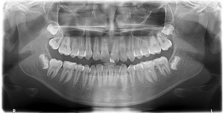 What are OPG and CBCT scans... and why you may need one? — tooth dental ...
