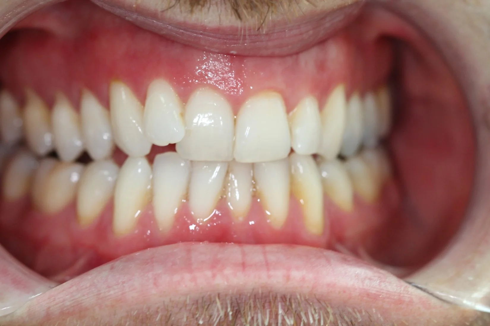 Invisalign Clear Braces at tooth SE1 — tooth dental care in Waterloo ...