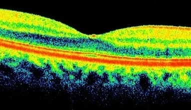 Peter A. Karth, MD, MBA, FASRS, FACS: Orgon's Retina Specialist