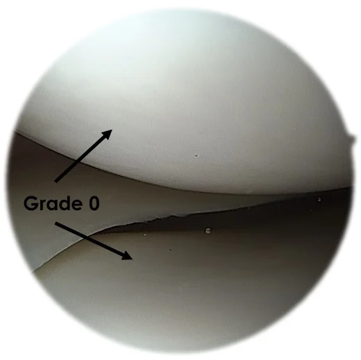 Cartilage Grading : Outerbridge Scale — Christopher J. Wahl, MD ...