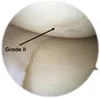 Cartilage Grading : Outerbridge Scale — Christopher J. Wahl, MD ...