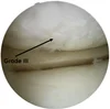 Cartilage Grading : Outerbridge Scale — Christopher J. Wahl, MD ...