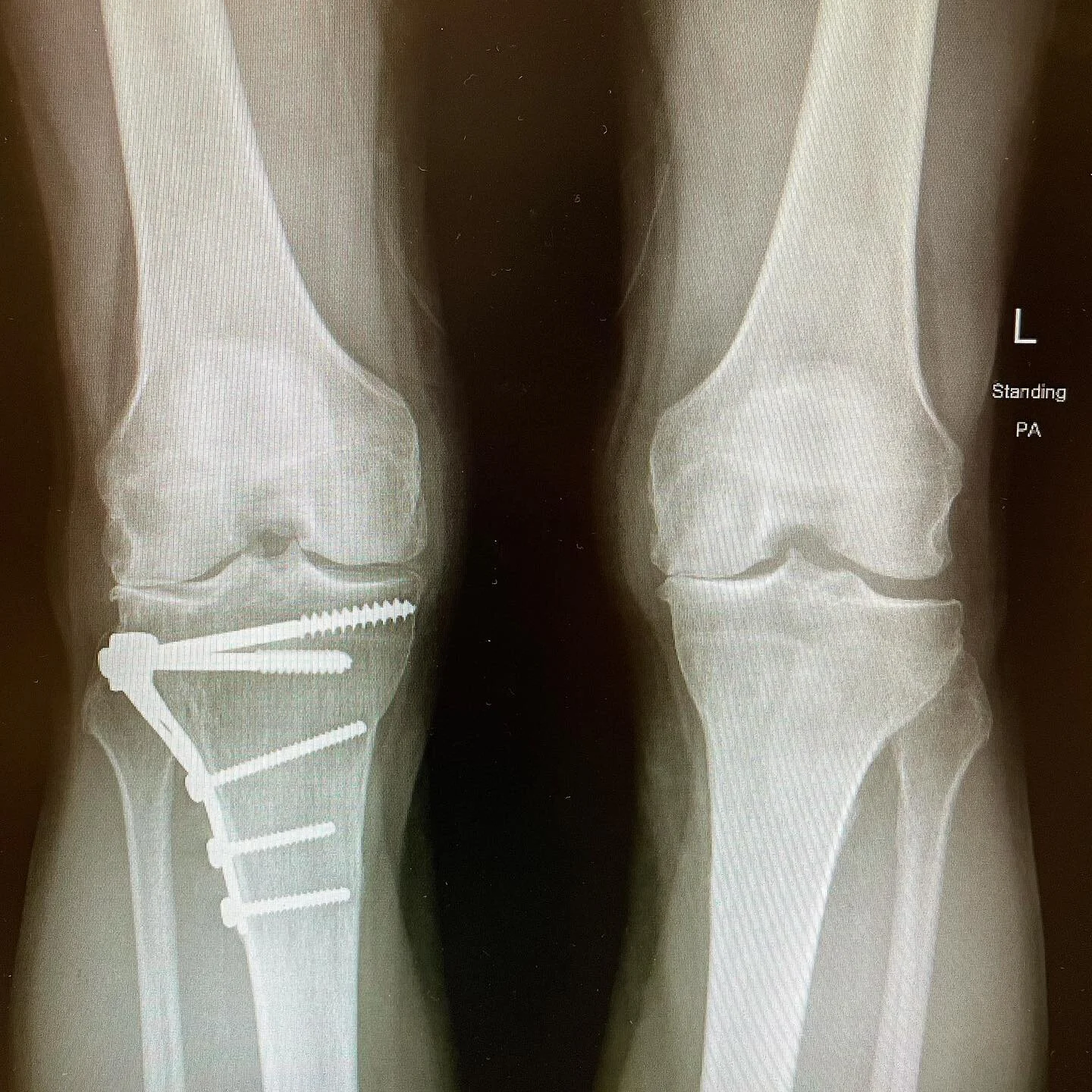 Cartilage Grading : Outerbridge Scale — Christopher J. Wahl, MD ...