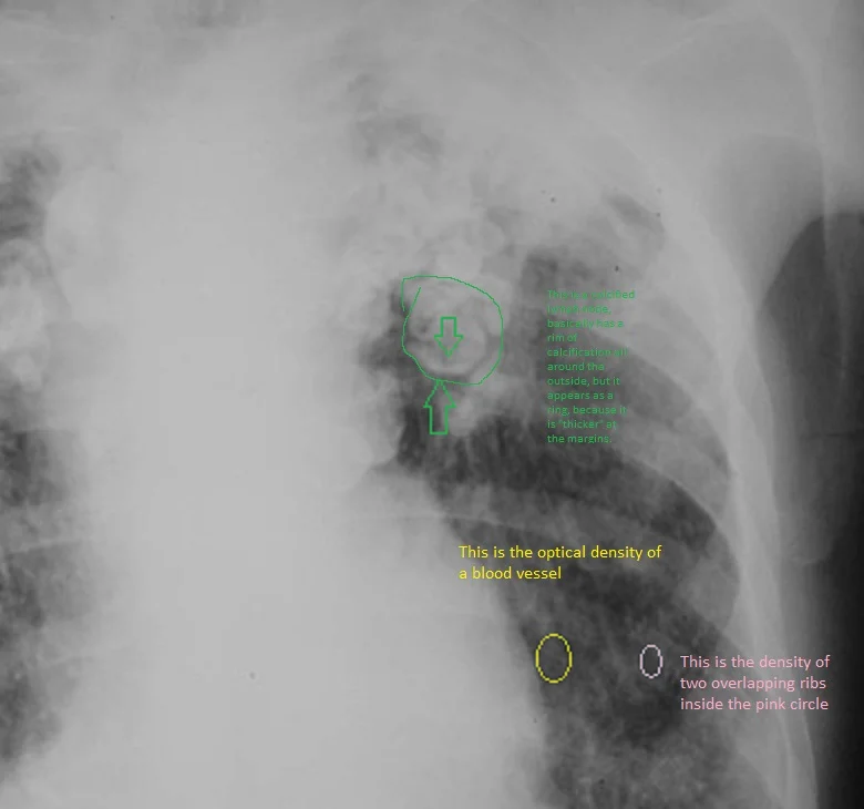 The Betz Sphere X-rays — Astonishing Legends