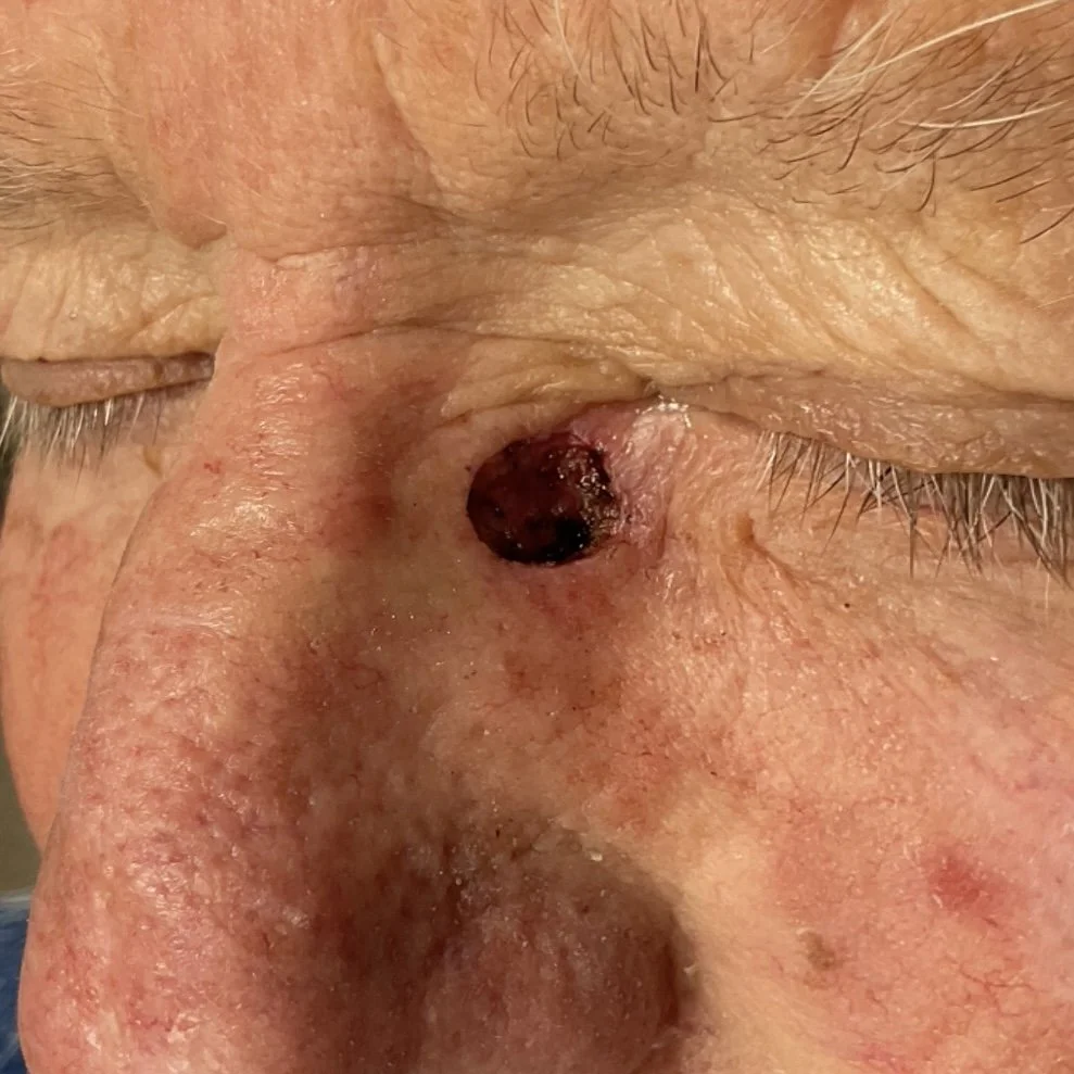 MOHS Surgery Results Before & After Pictures — Bella Cara Dermatology